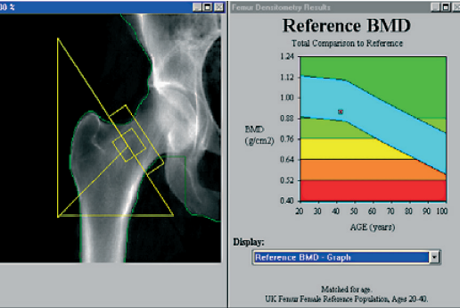 Sonac Calbon N - Calcium - Dietary Supplement - FDA Approved
